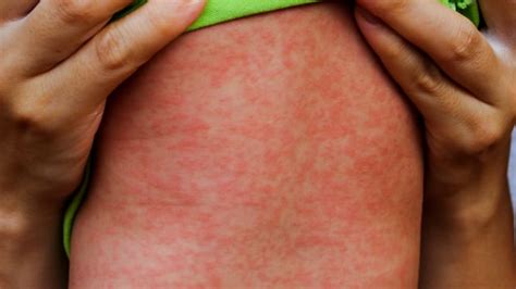 6 Infants Born With Congenital Measles From Unvaccinated Mothers In