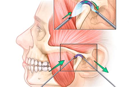 Affordable Premium Tmj Clinic In The Philippines Novodental
