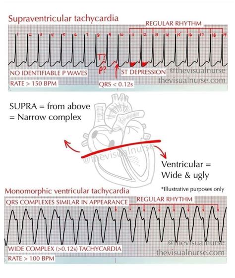 Vt Versus Svt At A Glance 💨 ️fast ️no Identifiable P Waves ️may Be