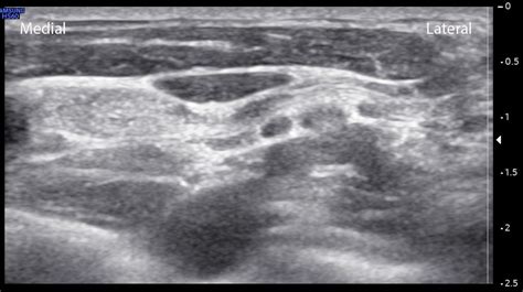 Regional Anesthesia Upper Extremity