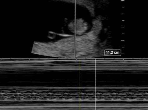 Subchorionic Bleed 10 Week Pregnancy Critical Care Sonography