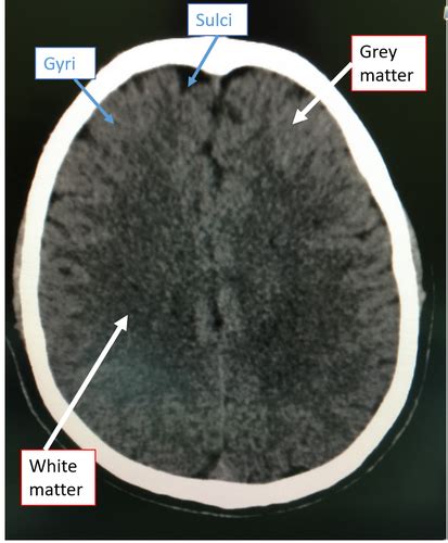 CT Scan MRI Flashcards Quizlet CT Scan MRI Flashcards Quizlet