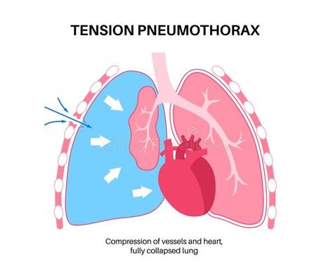 Hemopneumothorax Diagram