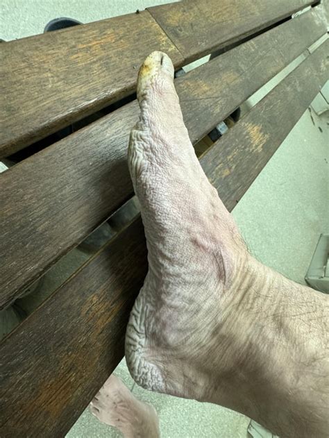 Trench Foot The Danger Of Trench Foot Foy Safety