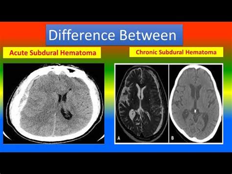 Distinction Between Acute Subdural Hematoma And Chronic Subdural