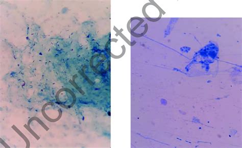 Microscopic Slide Images Right Positive Tuberculosis Microscopic