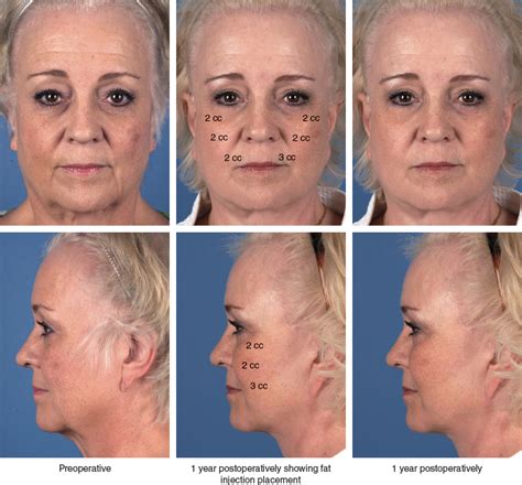 Chapter 49 Anatomy And Histology Of The Fat Compartments Of The Face
