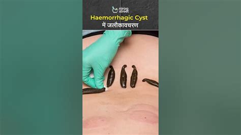 Leech Therapy For Haemorrhagic Cyst Youtube