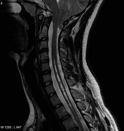 Syringomyelia Spinal Cord