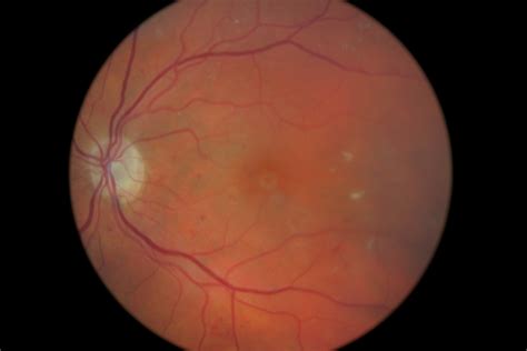 Glaucoma Object Detection Dataset And Pre Trained Model By Glaucoma