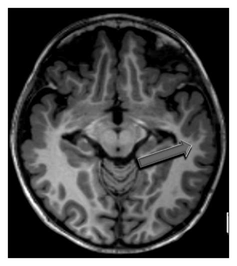 Axial A And Sagittal B Mprage Images Demonstrate Polymicrogyria