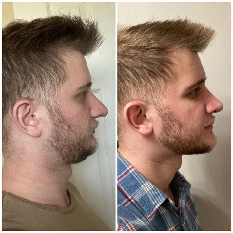 Class Iii Underbite Oral Surgeon Vs Orthodontist R Jawsurgery