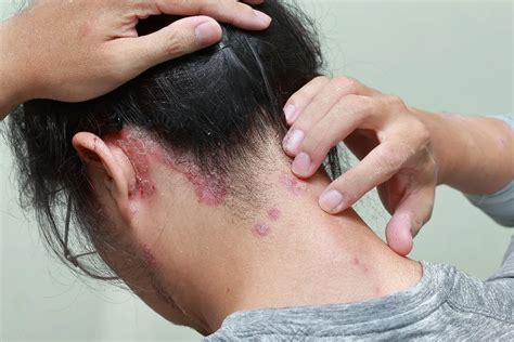 Effective Scalp Psoriasis Treatments Medical And Home Remedies Hands In