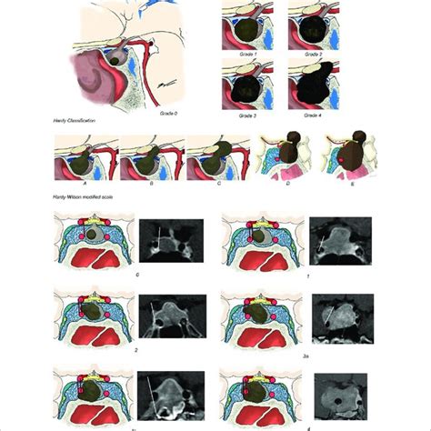 Hardy Wilson And Knosp Classifications Hardy Wilson Classification Download Scientific