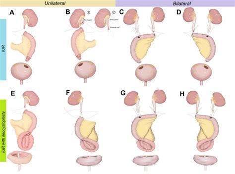Totally Intracorporeal Robot Assisted Unilateral Or Bilateral Ileal