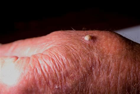 Squamous Cell Carcinoma In Georgia A Comprehensive Guide