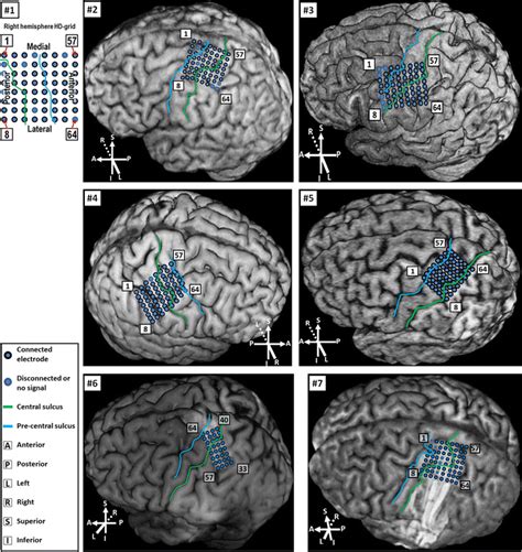 Location Of Hd Ecog Grids For Subjects 2 5 Locations Were Determined Download Scientific