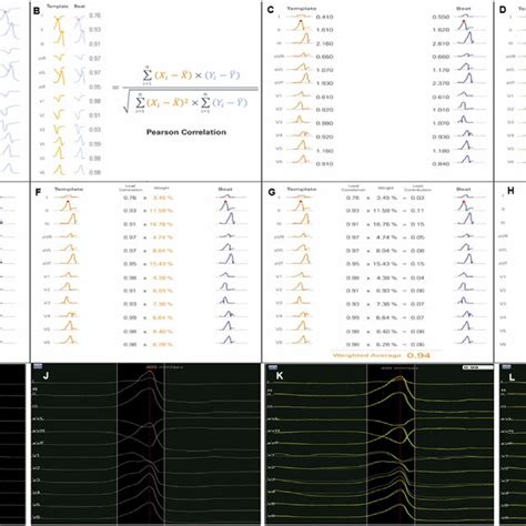 A Premature Ventricular Contraction Pvc Activation Map Projected In
