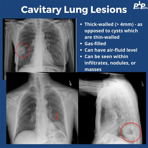 Radiology Rounds 9 5 23 Pulmpeeps