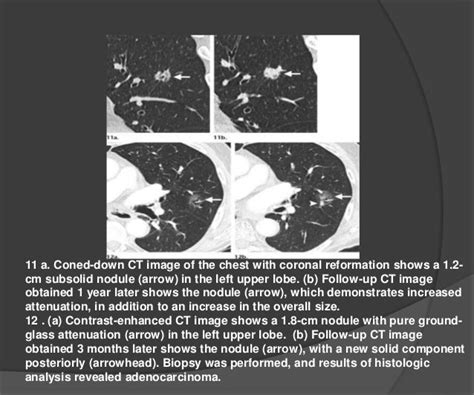 Solitary Pulmonary Nodule