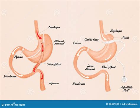 Gastric Bypass And Gastric Band Stock Illustration Illustration Of