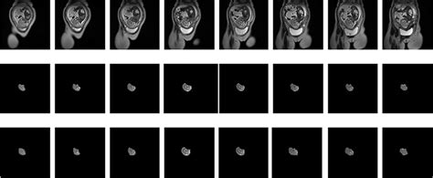 Segmented Fetal Brain Row 1 Shows Original T2 W Images Row 2 Shows