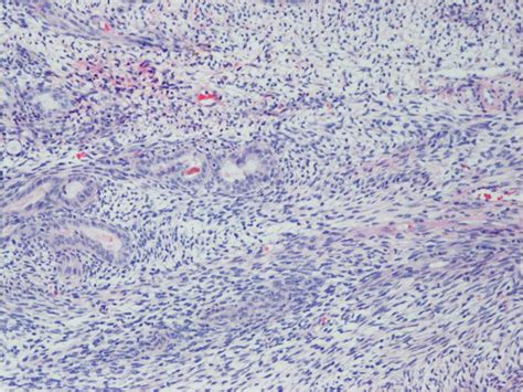 Synovial Sarcoma Tumor Surgery Network