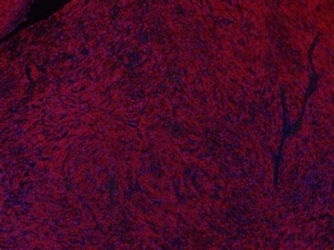 Could There Be A Gleevec For Brain Cancer