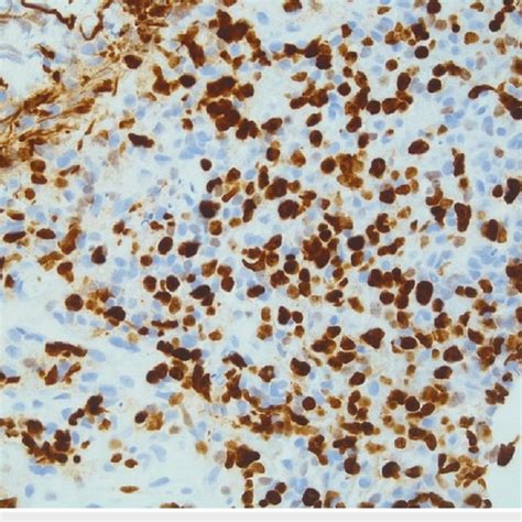 Ki 67 Staining Of Lymph Node 400x Power Download Scientific Diagram