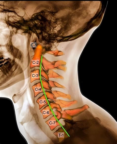 The Cervical Spine Consists Of ⏺️ 7 Vertebrae C1 Atlas C2 Axis