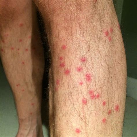 Midge Bites — How To Recognise Midges Treat Bites And Avoid Both