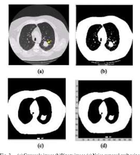 Figure 3 From Lung Nodule Detection In Ct Scan Image Based On Glcm And Rlm Features Using