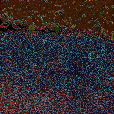 Cosmx® Smi Vs Xenium Comparative Analysis Of Breast Tissue Nanostring