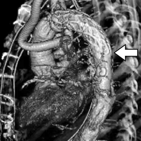 The Arrow Indicates The Distal Position Of Fet In Postoperative 3d Ct． Download Scientific Diagram