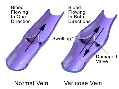 What Are The Common Problems Of Veins Cardiovisual