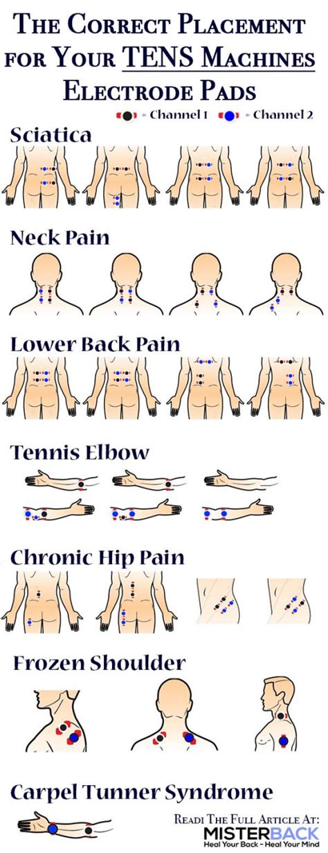 Correct Placement For Your Tens Machines Electrode Pads With Images