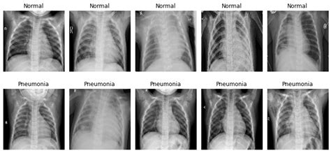 Github Stevegithinjiimage Classification Chest X Ray Images Pneumonia
