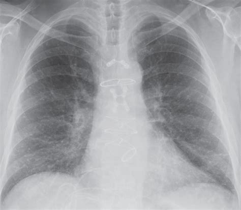 What Is A Apical Lung Nodule At Isabella Jolly Blog