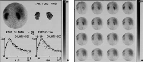 Exercise Renography Renogram And Sequential Images Bilateral Normal Download Scientific