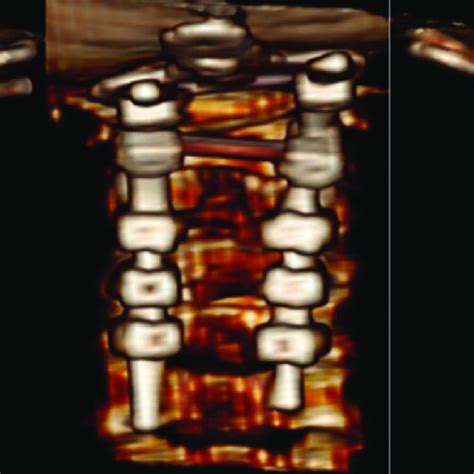Occipitocervical Fixation With Occipital Plate Four Poly Axial Trans