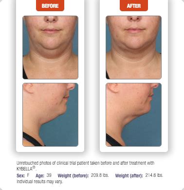 Labiaplasty Before And After Photo Gallery