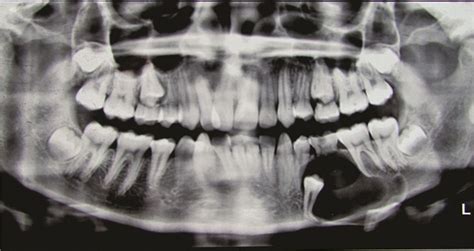 Marsupialisation A Treatment Modality Of A Dentigerous Cyst Bmj Case Reports