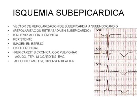 Isquemia Lesion Y Necrosis Cambios Ekg Isquemia Onda