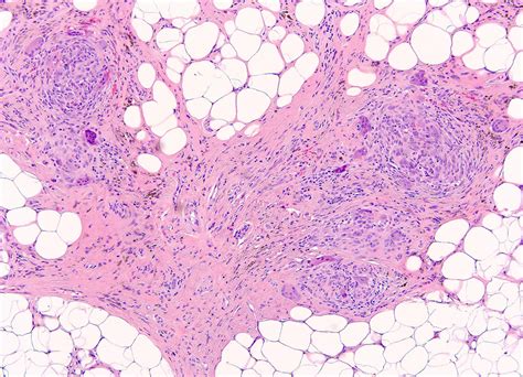 Pathology Outlines Plexiform Fibrohistiocytic Tumor