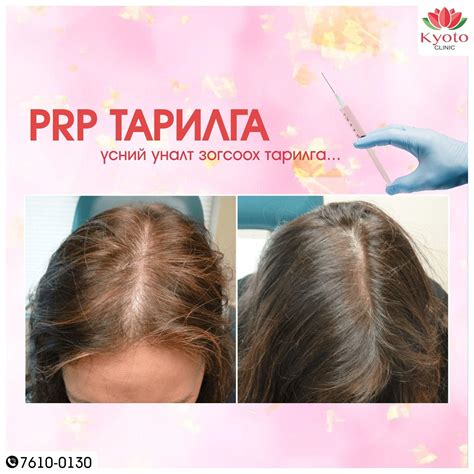 Kyoto ХУЙХНЫ ЭМЧИЛГЭЭ 🧬 Эмчилгээ хийлгэх хэрэгтэй хүмүүс ҮС УНАЖ ХУГАРЧ ГЭМТЭХ ҮС ХАЛЗРАХ ҮС