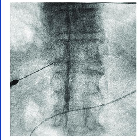 X Ray Image Of The Thoracic Spine Radiofrequency Thermocoagulation Is