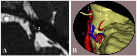 Surgeries Free Full Text Endoscopically Assisted Exoscopic Surgery