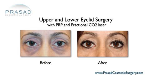 Laser Treatment For Dark Circles Under Eyes Dr Prasad Blog