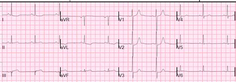 2 Examples Of Posterior Reperfusion T Waves Dr Smiths Ecg Blog