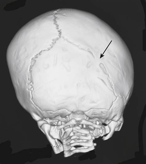 Lambdoid Craniosynostosis Clinical Tree